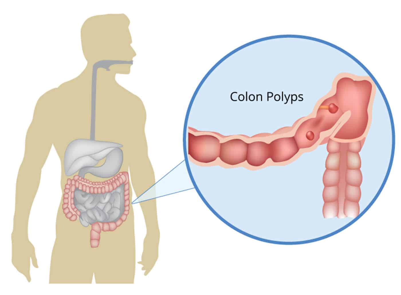 Polyp đại tràng: Nguyên nhân, triệu chứng và điều trị