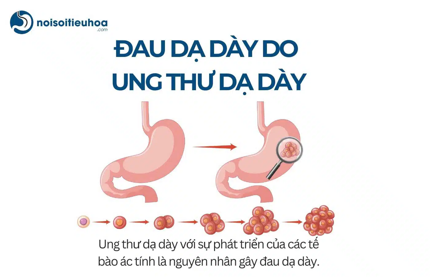 Đau dạ dày: Nguyên nhân, dấu hiệu và cách điều trị